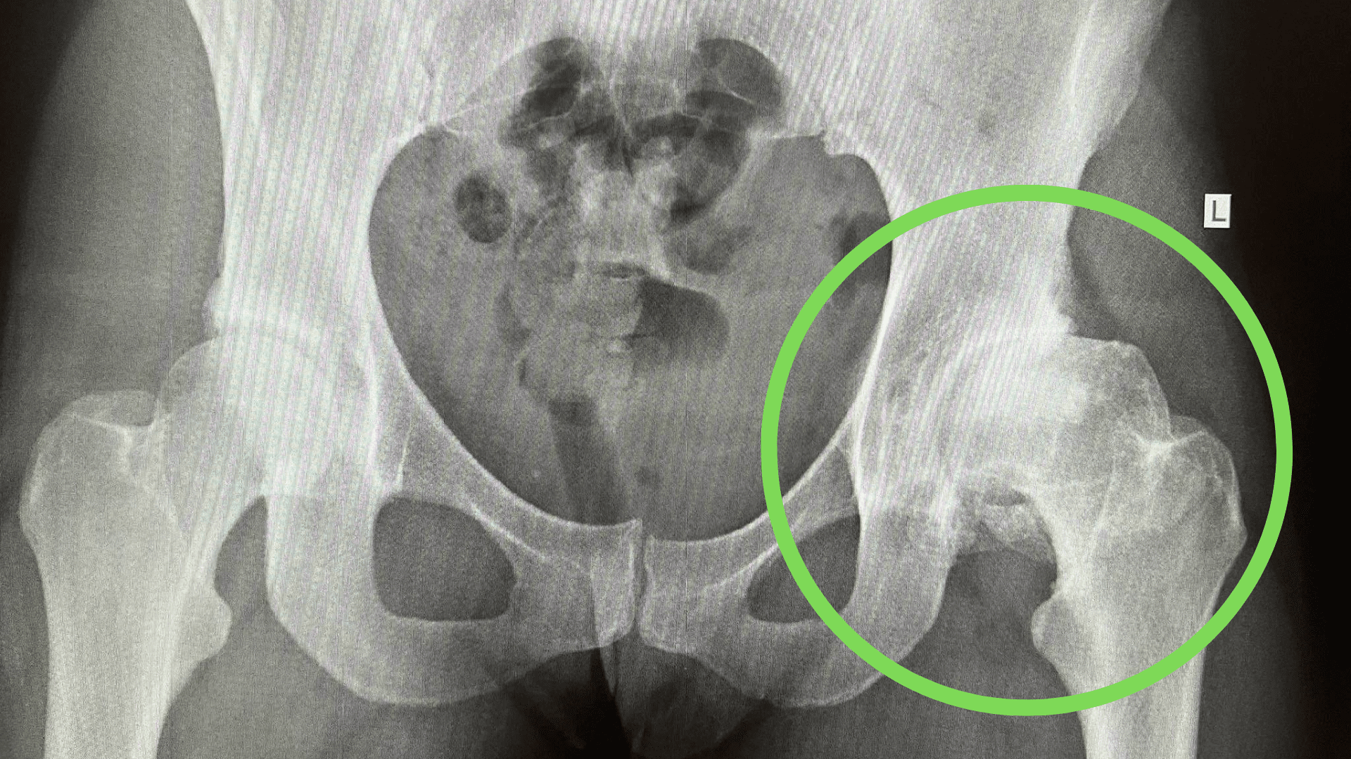 Zrzutka: Operacja biodra i życie bez bólu | Katarzyna Strzelecka